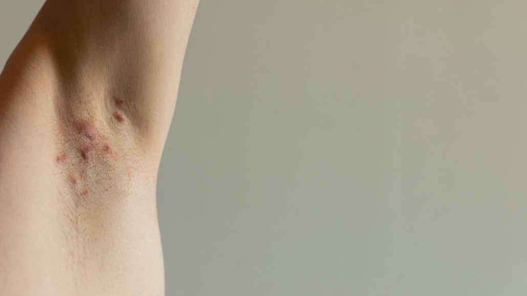 MALADIE DE VERNEUIL - Reso dermatologie