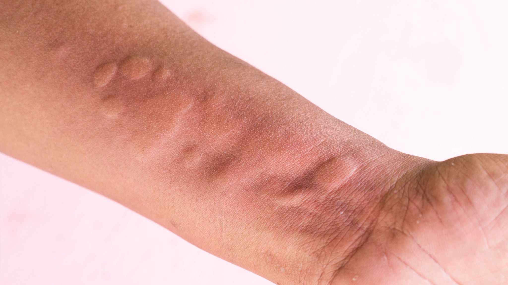 L'urticaire chronique spontanée