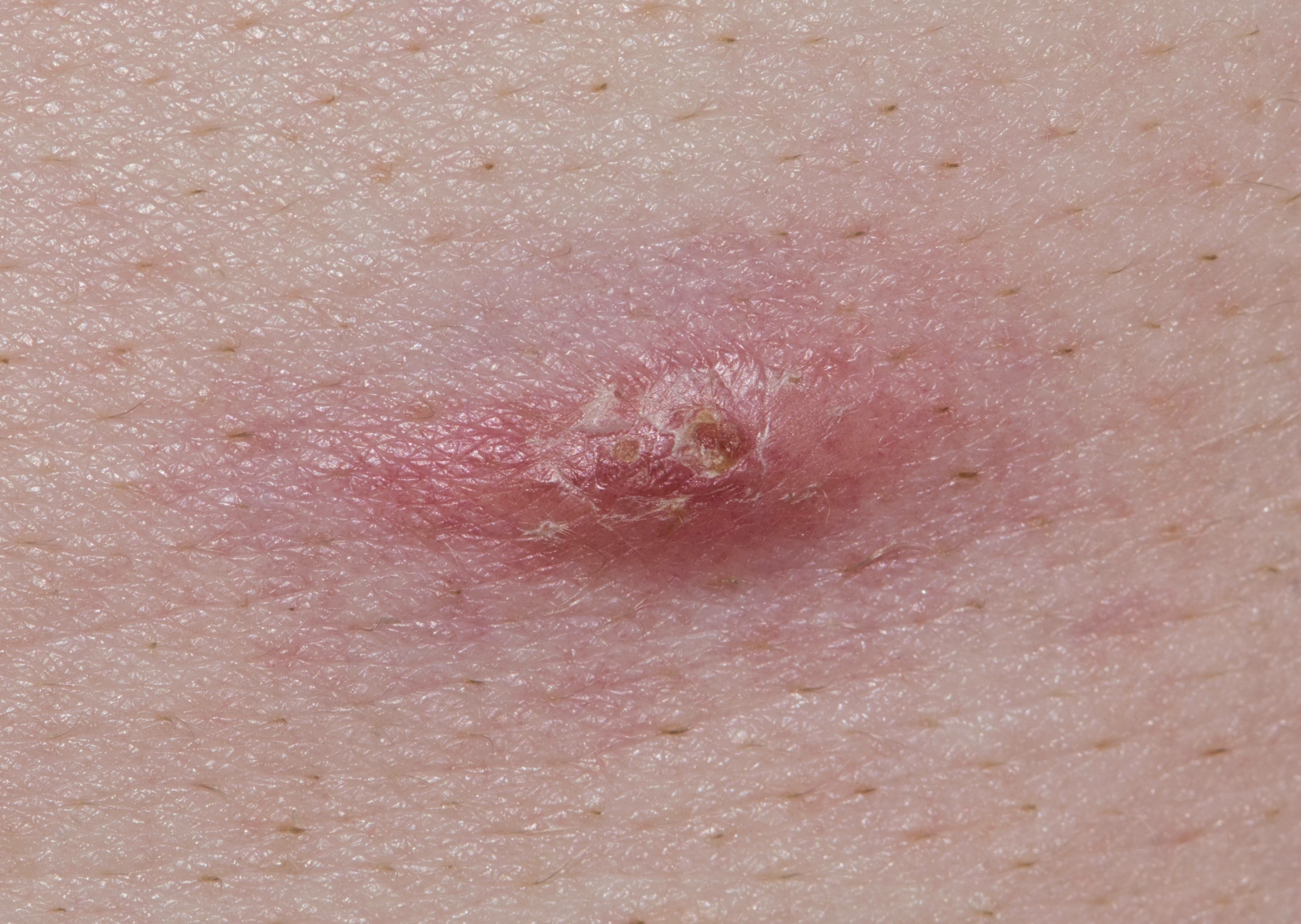 Le prurigo nodulaire - Reso dermatologie