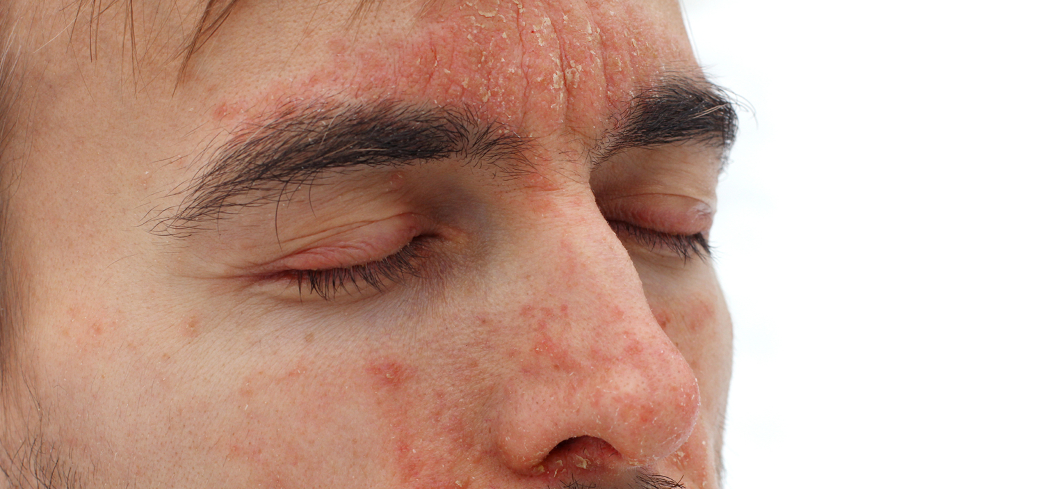 Comment soigner le psoriasis du visage