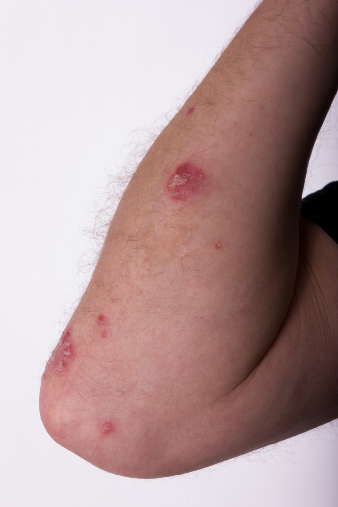 Le psoriasis en gouttes - Reso dermatologie
