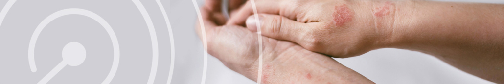 Le psoriasis en gouttes - Reso dermatologie