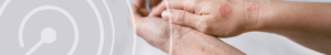 Le psoriasis en gouttes - Reso dermatologie
