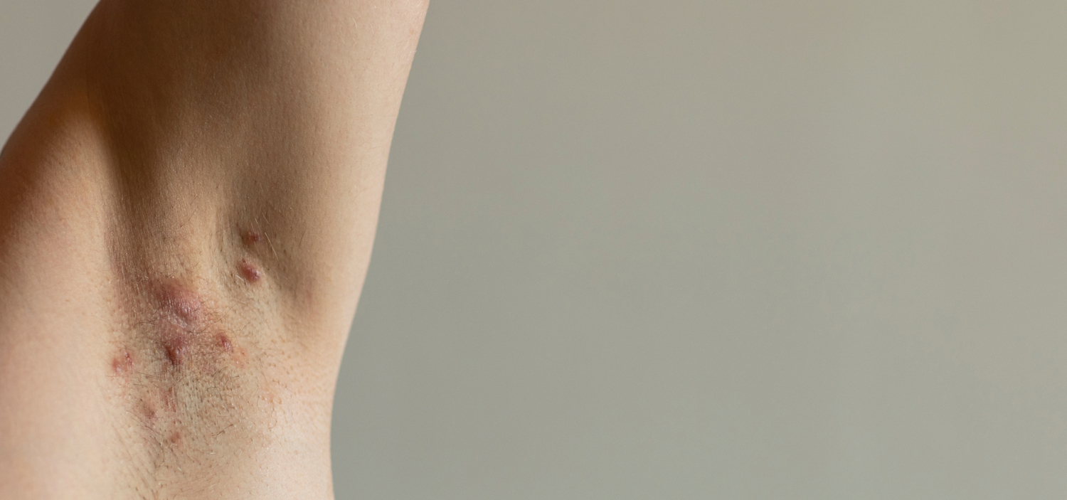 Maladie de Verneuil : une prise en charge globale