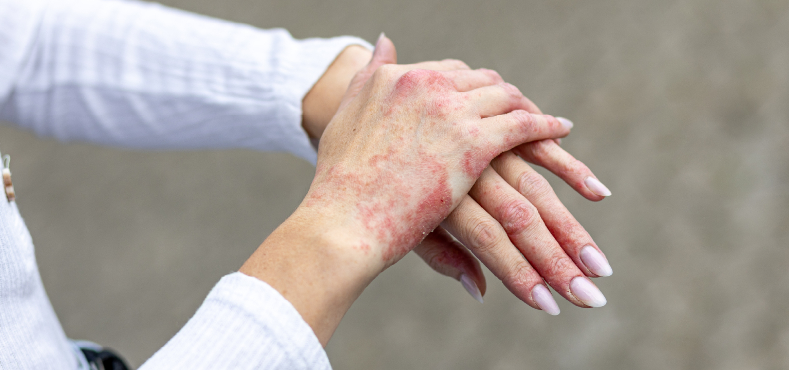eczéma chronique des mains